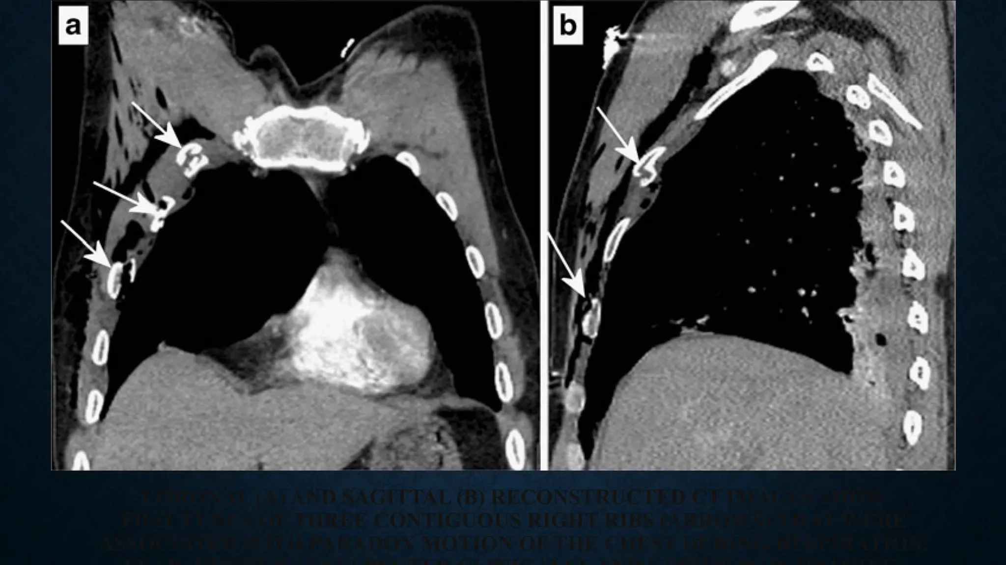 thoracic and abdominal trauma radiology finding | PPTX