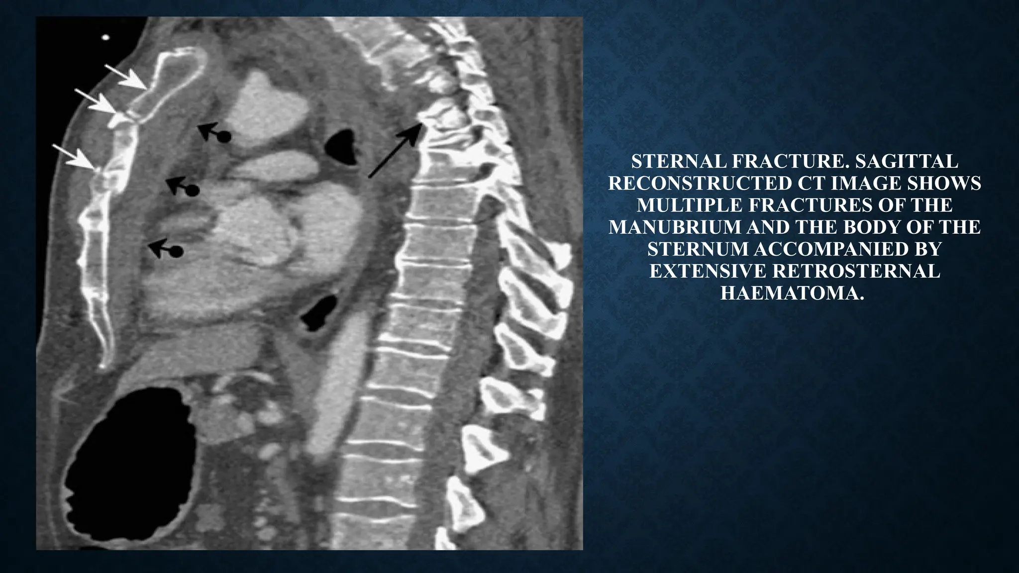 thoracic and abdominal trauma radiology finding | PPTX