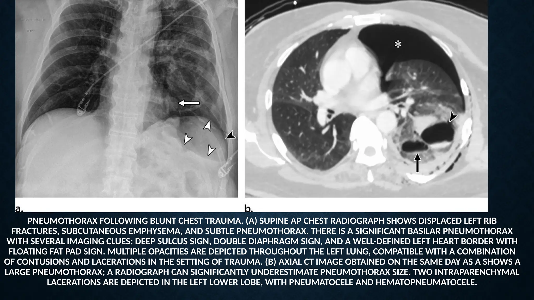 thoracic and abdominal trauma radiology finding | PPTX