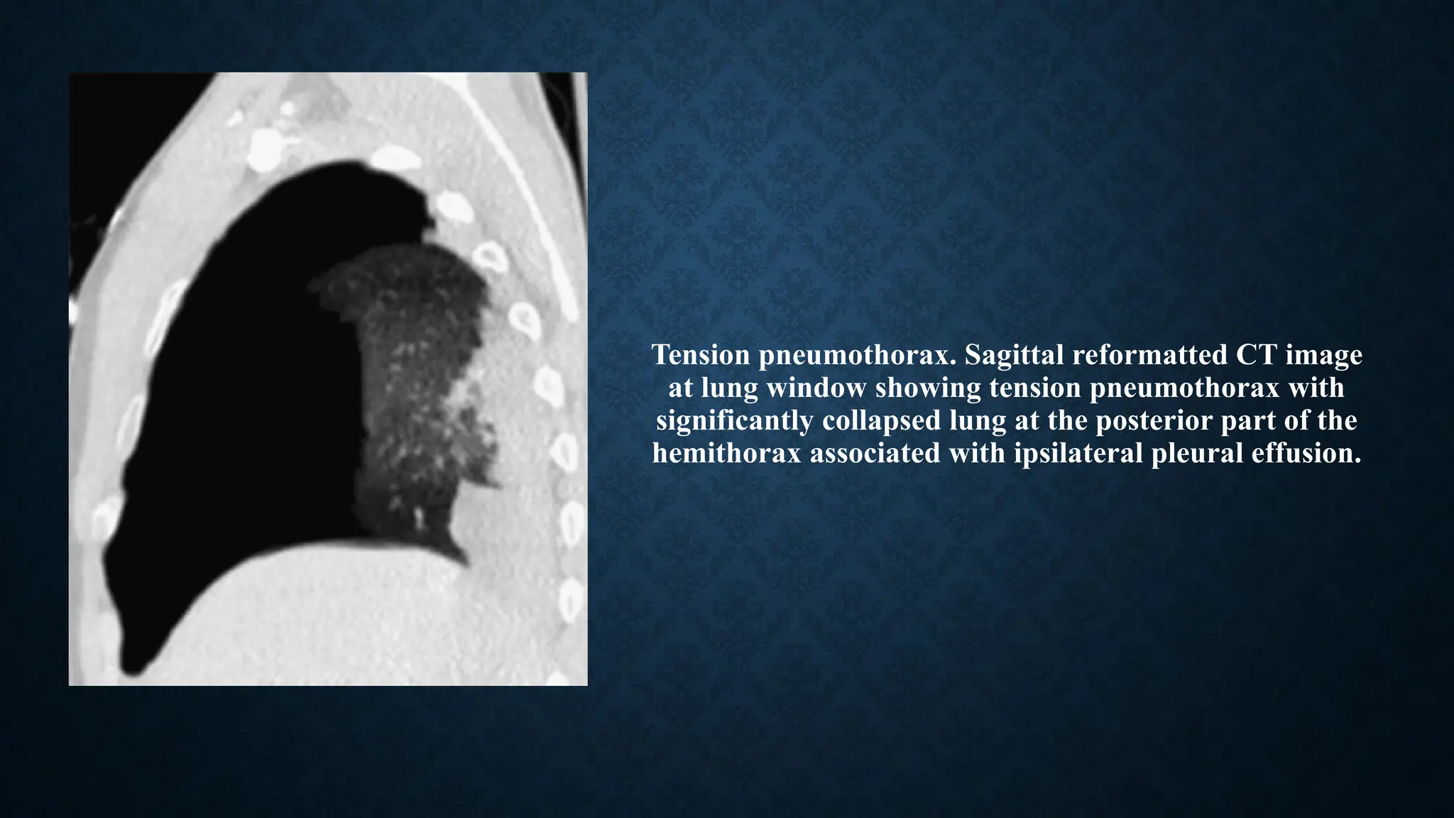 Radiological findings of Thoracic and abdominal trauma modified | PPT