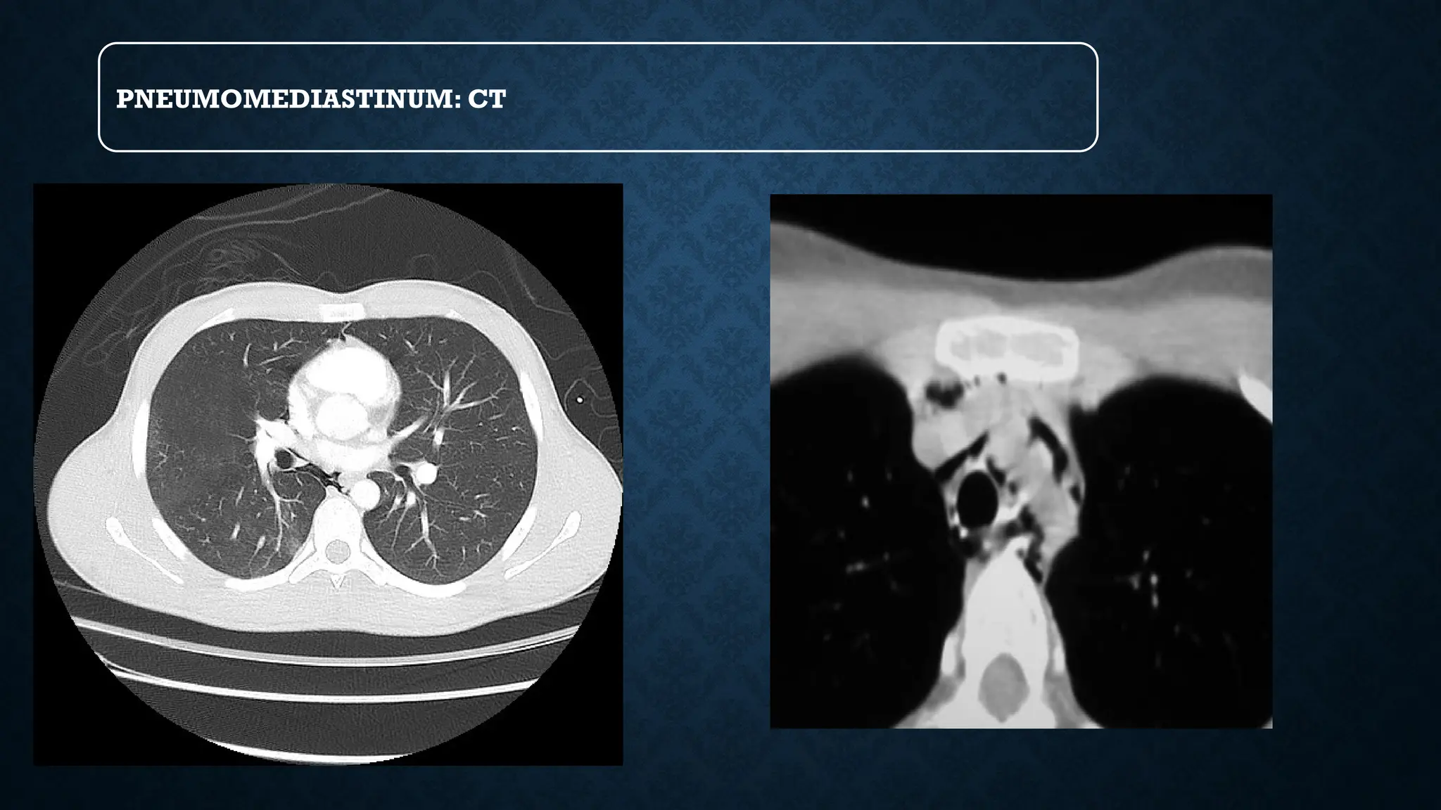 Radiological findings of Thoracic and abdominal trauma modified | PPT