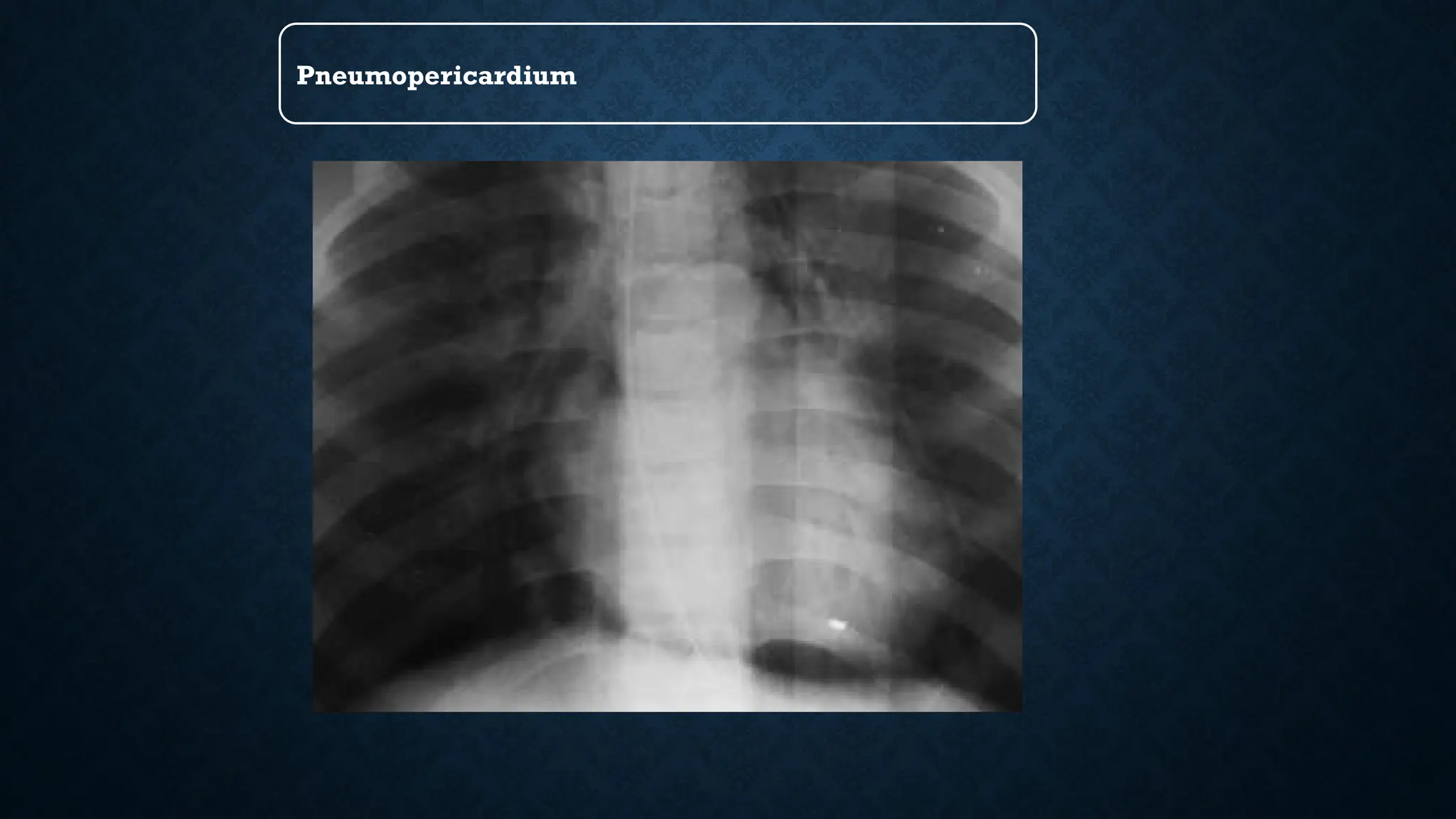 Radiological findings of Thoracic and abdominal trauma modified | PPT