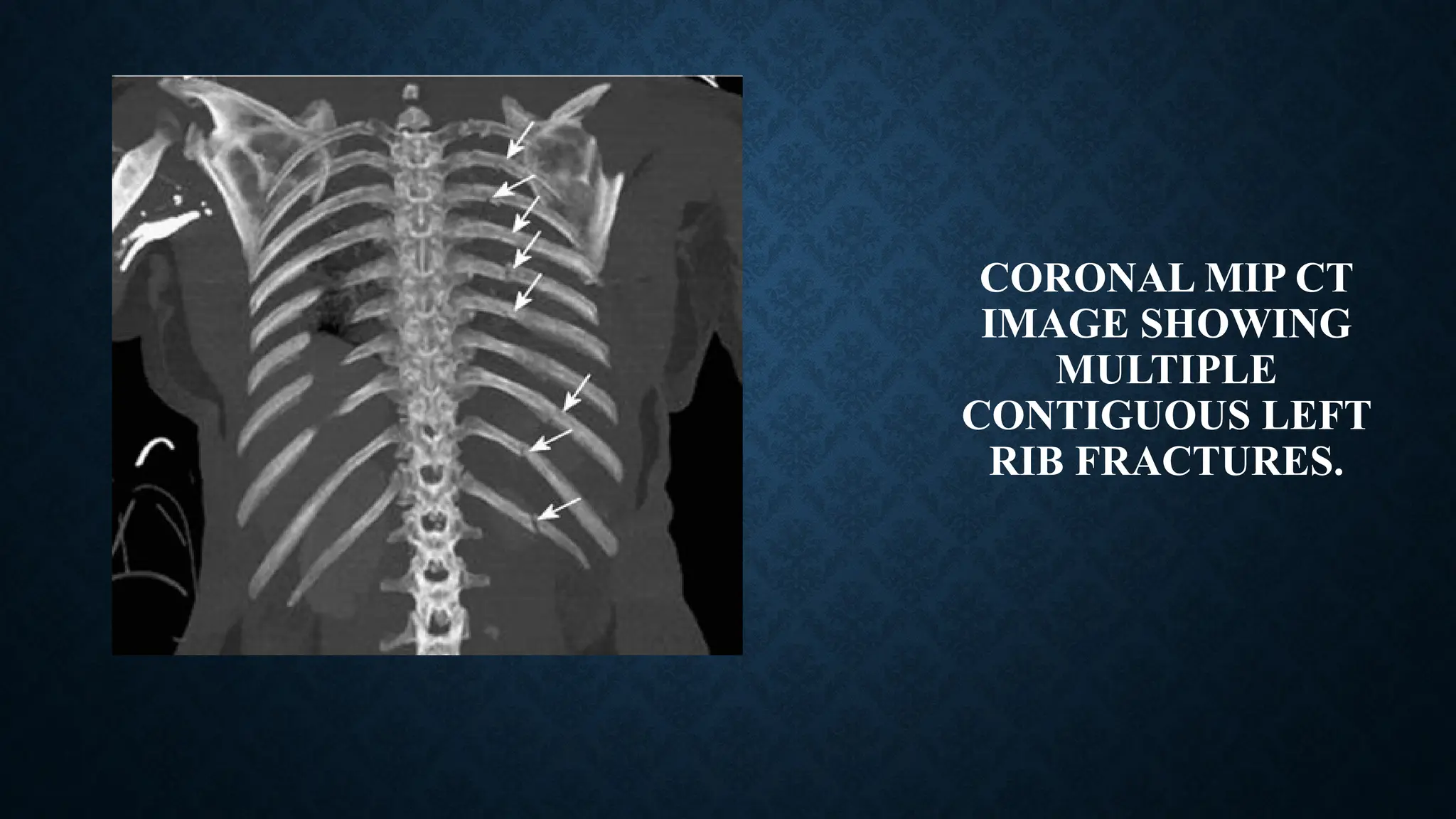 Radiological findings of Thoracic and abdominal trauma modified | PPT