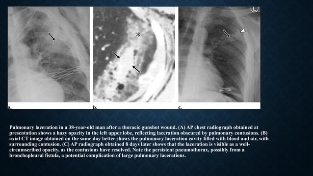 Radiological findings of Thoracic and abdominal trauma modified | PPT