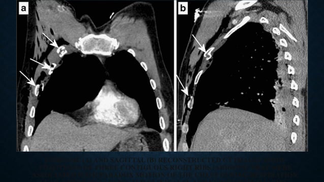 Radiological findings of Thoracic and abdominal trauma modified | PPT