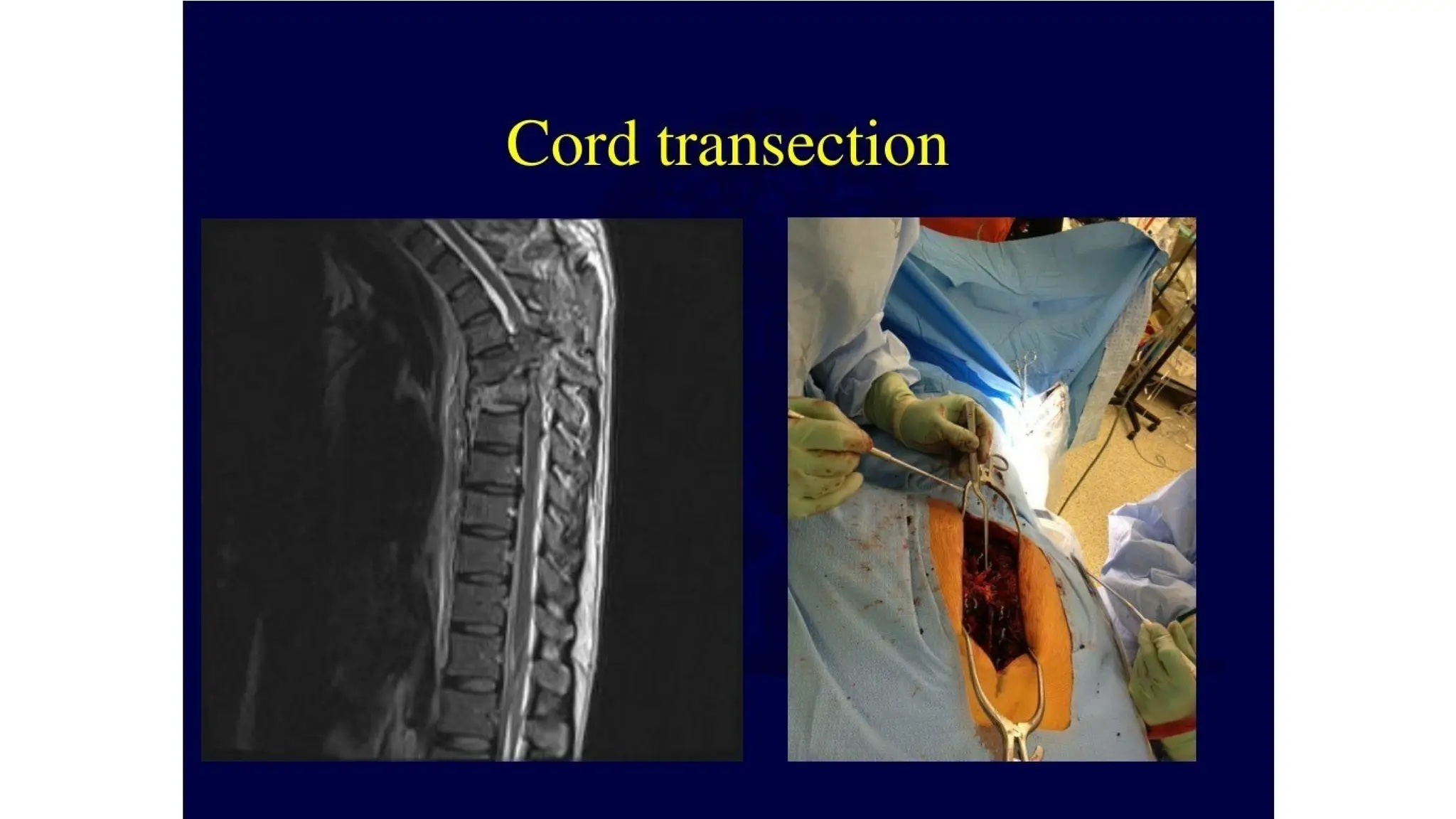 Thoracic and Lumbar Spine Fractures and Dislocations Assessment and ...