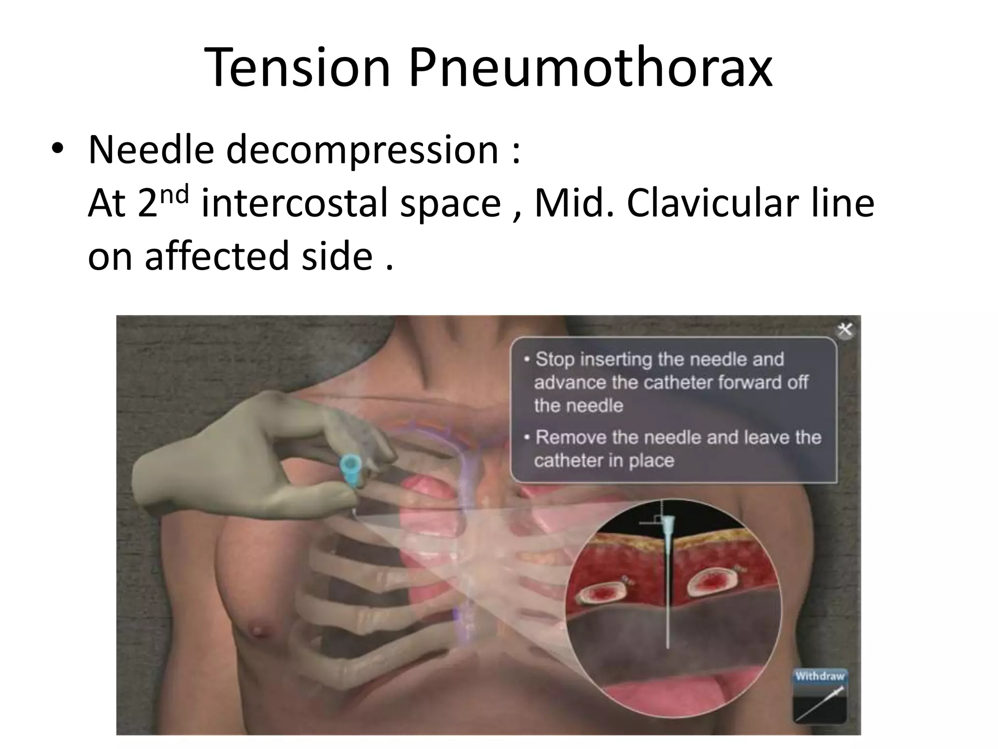 Thoracic and Vascular Injuries in battlefield.pptx