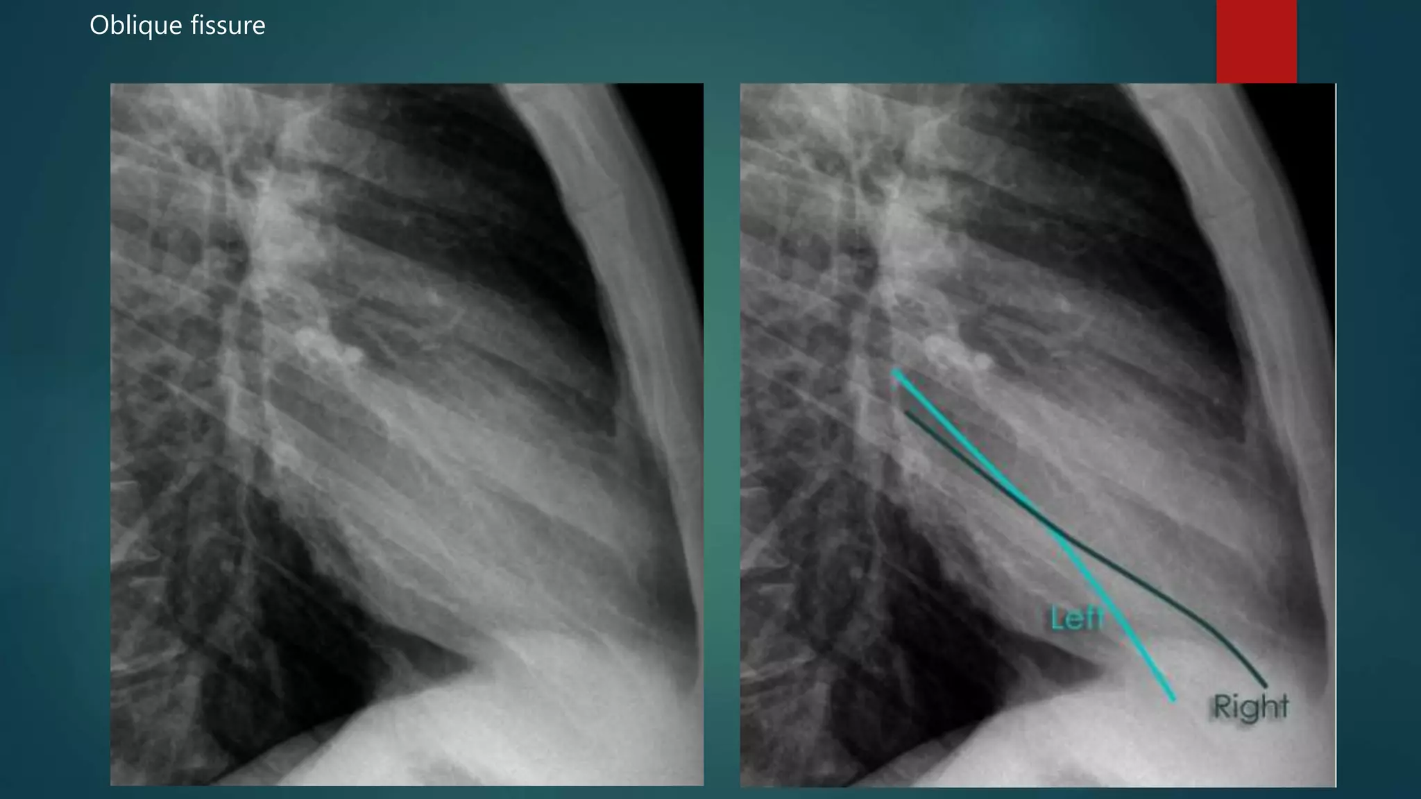 Thoracic anatomy on various imaging modalities | PPT Thoracic anatomy on various imaging modalities | PPT