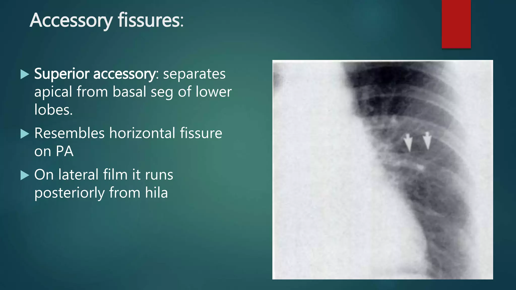 Thoracic anatomy on various imaging modalities | PPTX