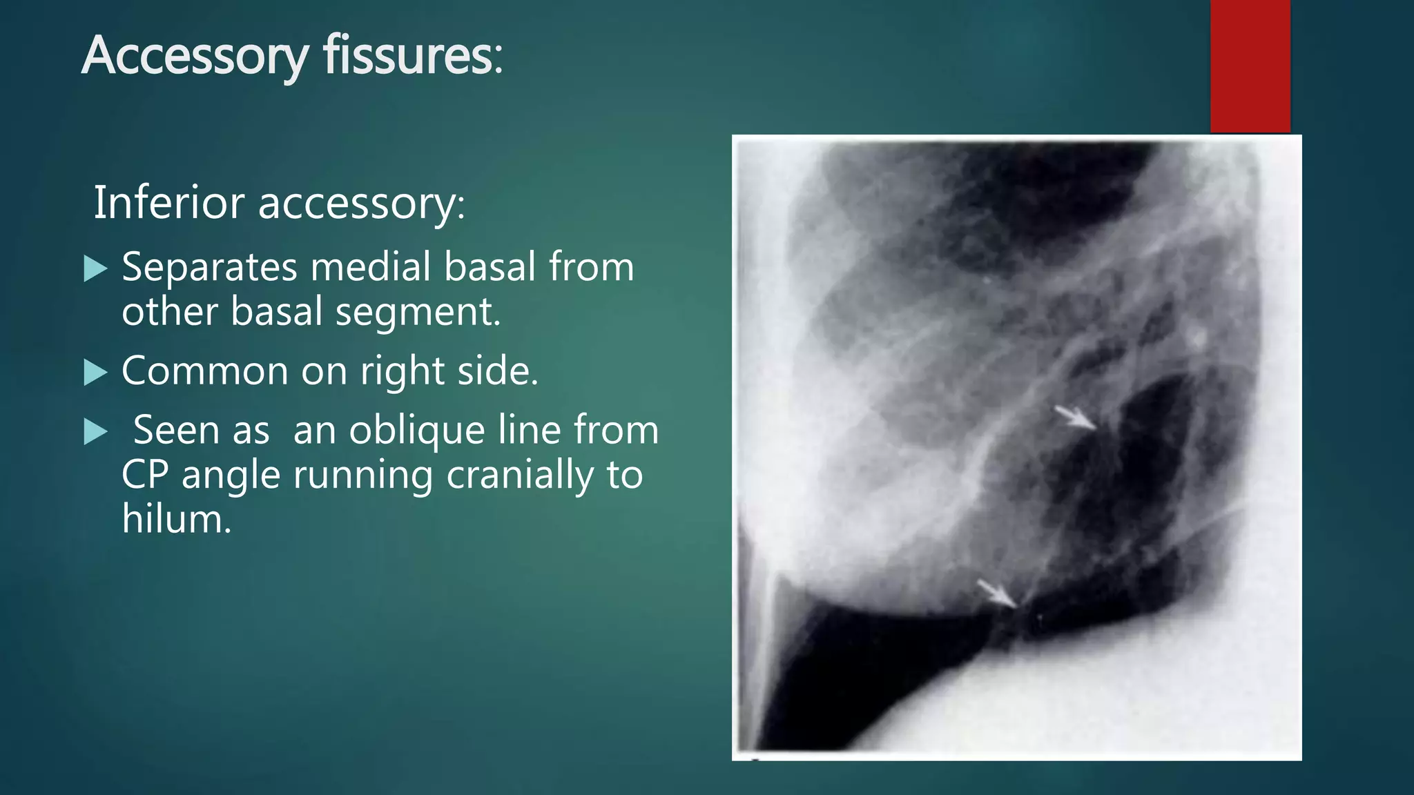 Thoracic anatomy on various imaging modalities | PPTX