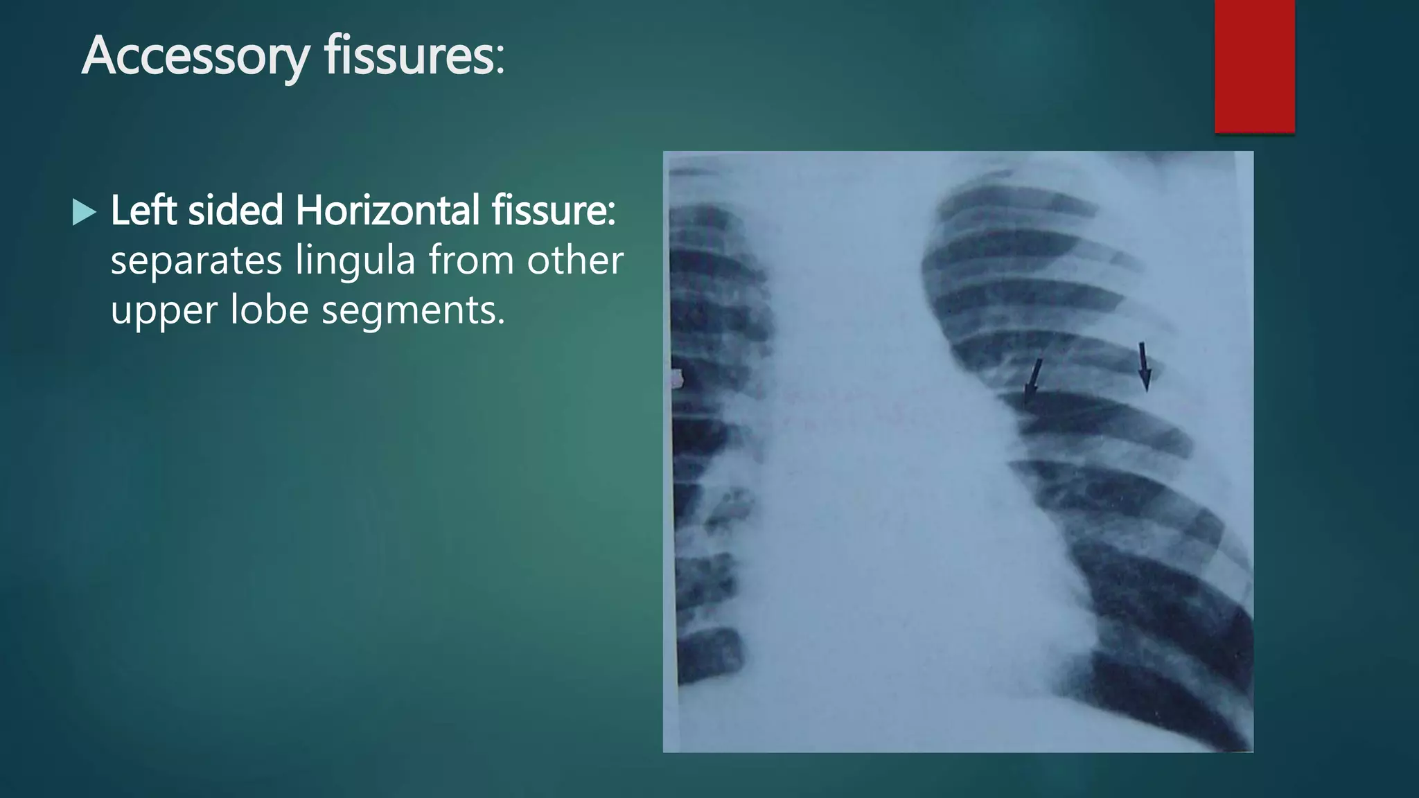 Thoracic anatomy on various imaging modalities | PPT Thoracic anatomy on various imaging modalities | PPT