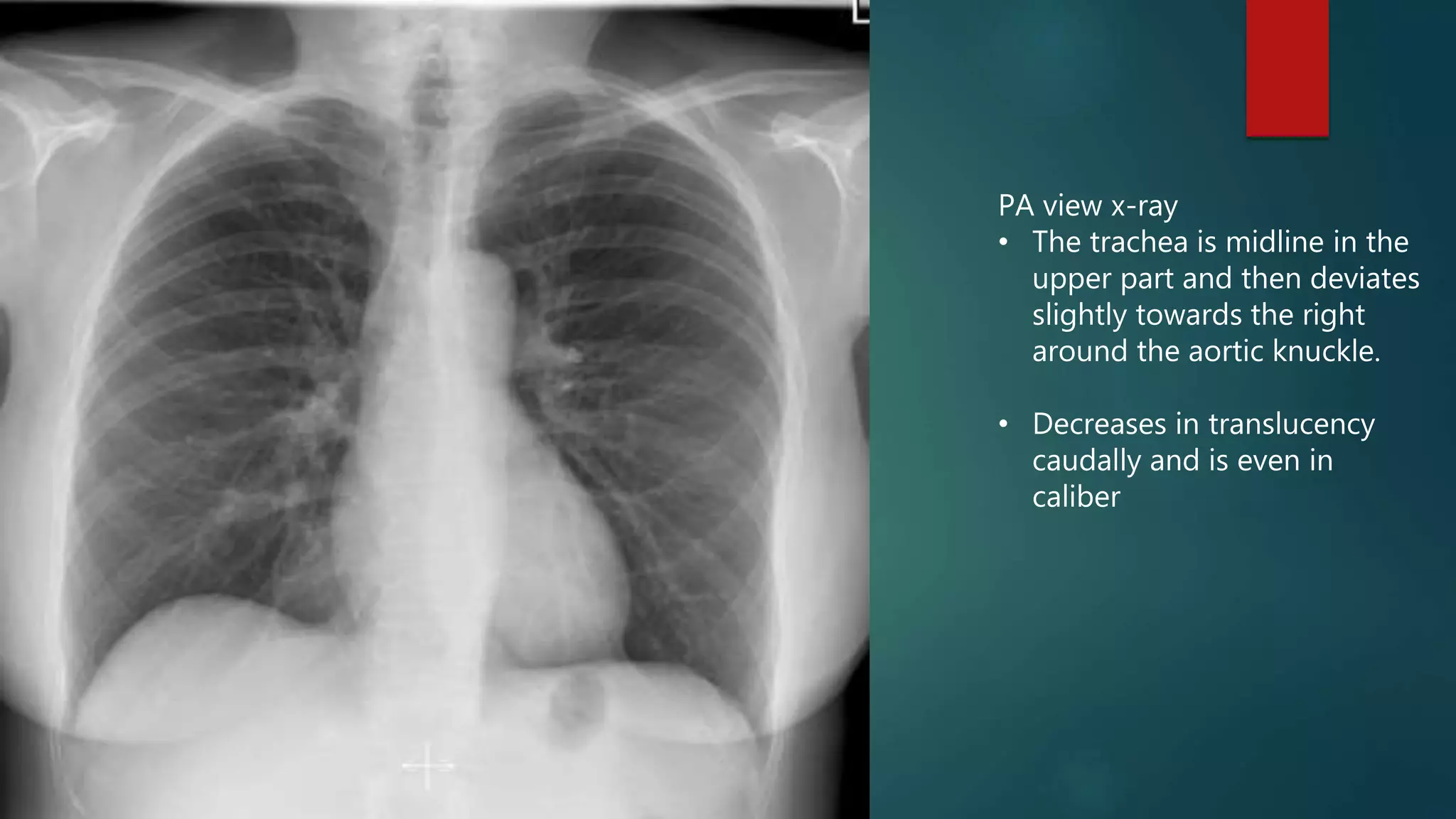 Thoracic anatomy on various imaging modalities | PPTX