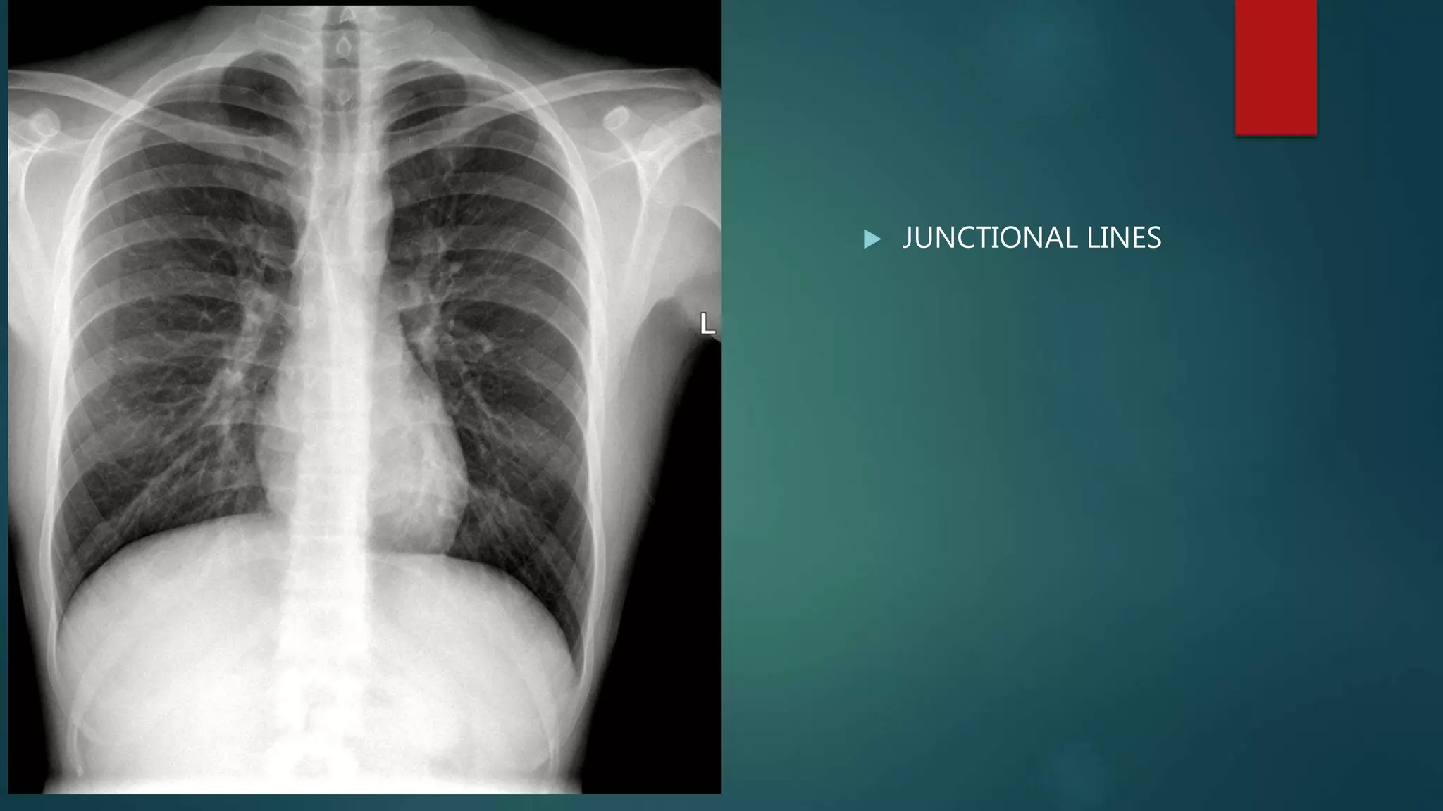 Thoracic anatomy on various imaging modalities | PPTX