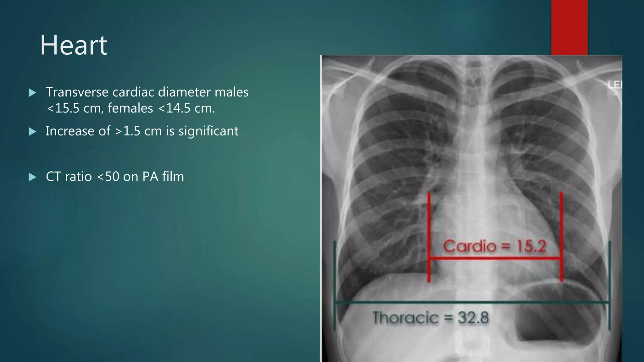 Thoracic anatomy on various imaging modalities | PPTX | Lung and ...