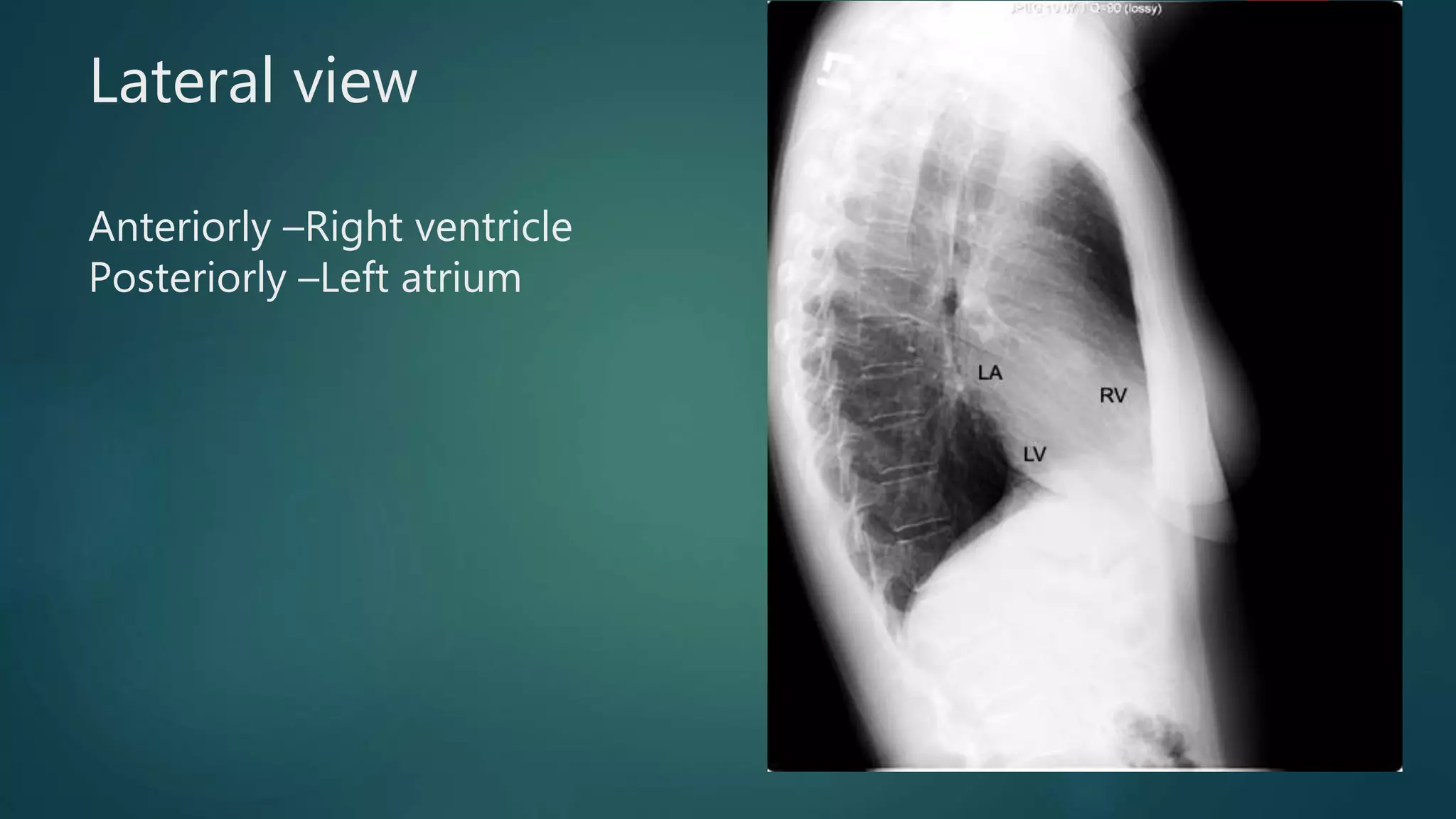 Thoracic anatomy on various imaging modalities | PPTX