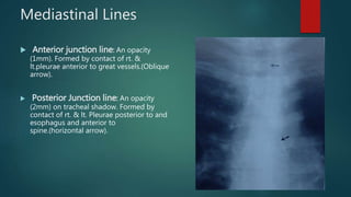 Thoracic anatomy on various imaging modalities | PPTX
