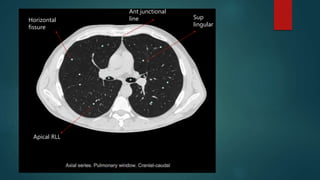 Thoracic anatomy on various imaging modalities | PPTX