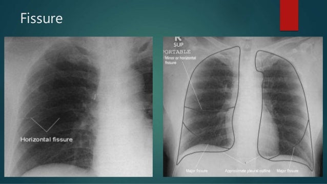 Thoracic anatomy on various imaging modalities