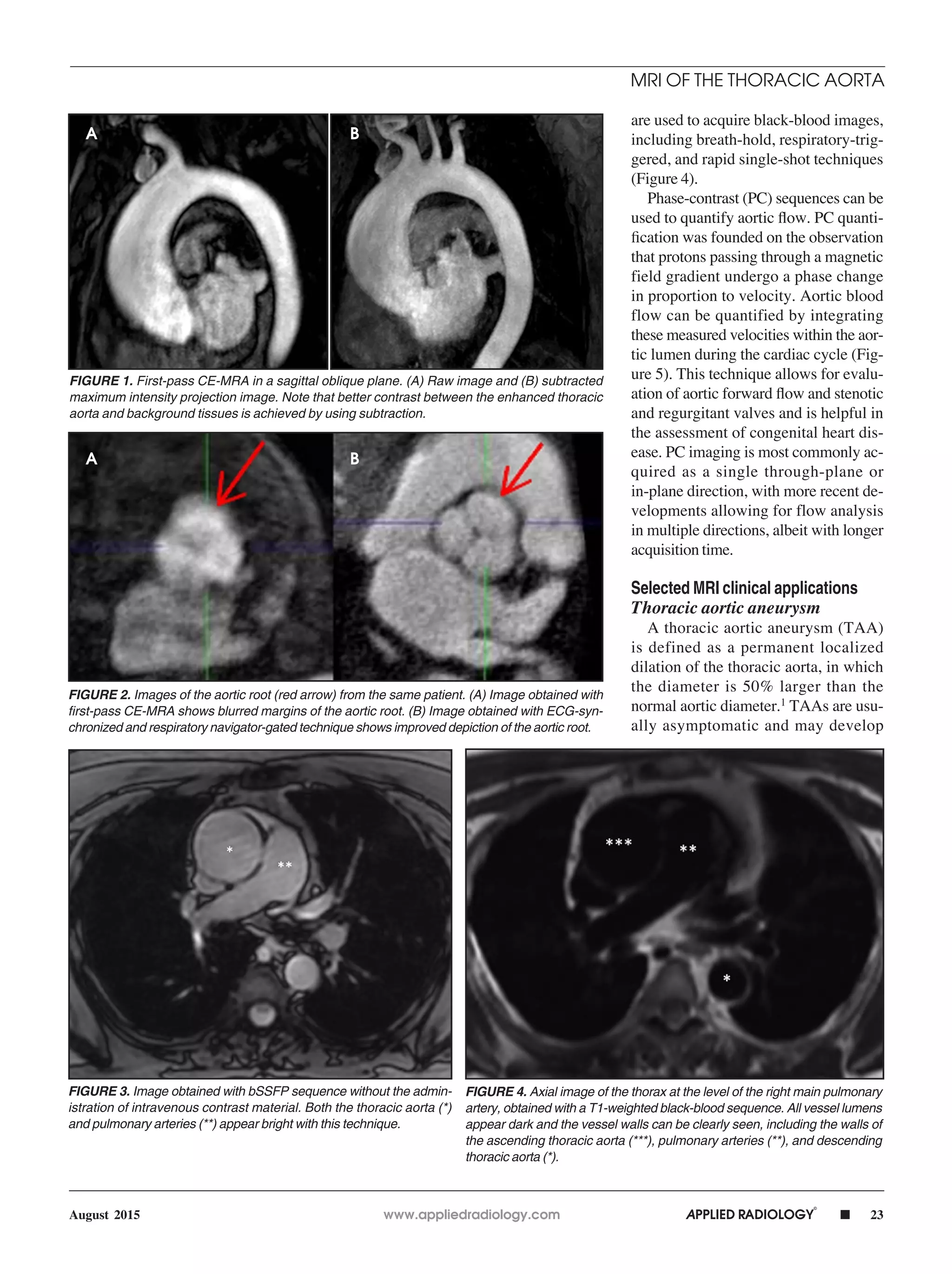 Thoracic aorta mri nice | PDF
