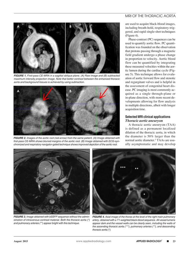 Thoracic aorta mri nice | PDF
