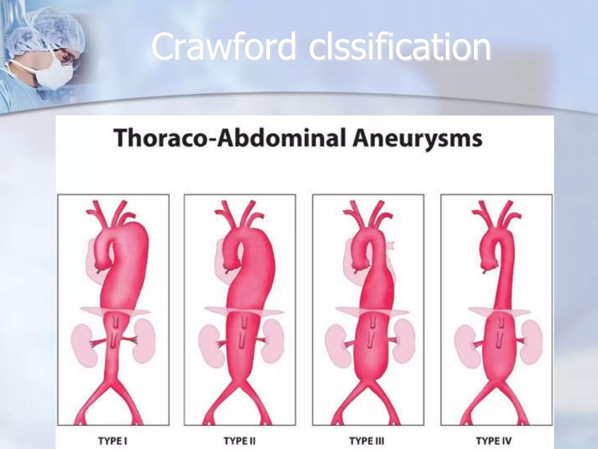 Thoracic aortic aneurysm | PPTX