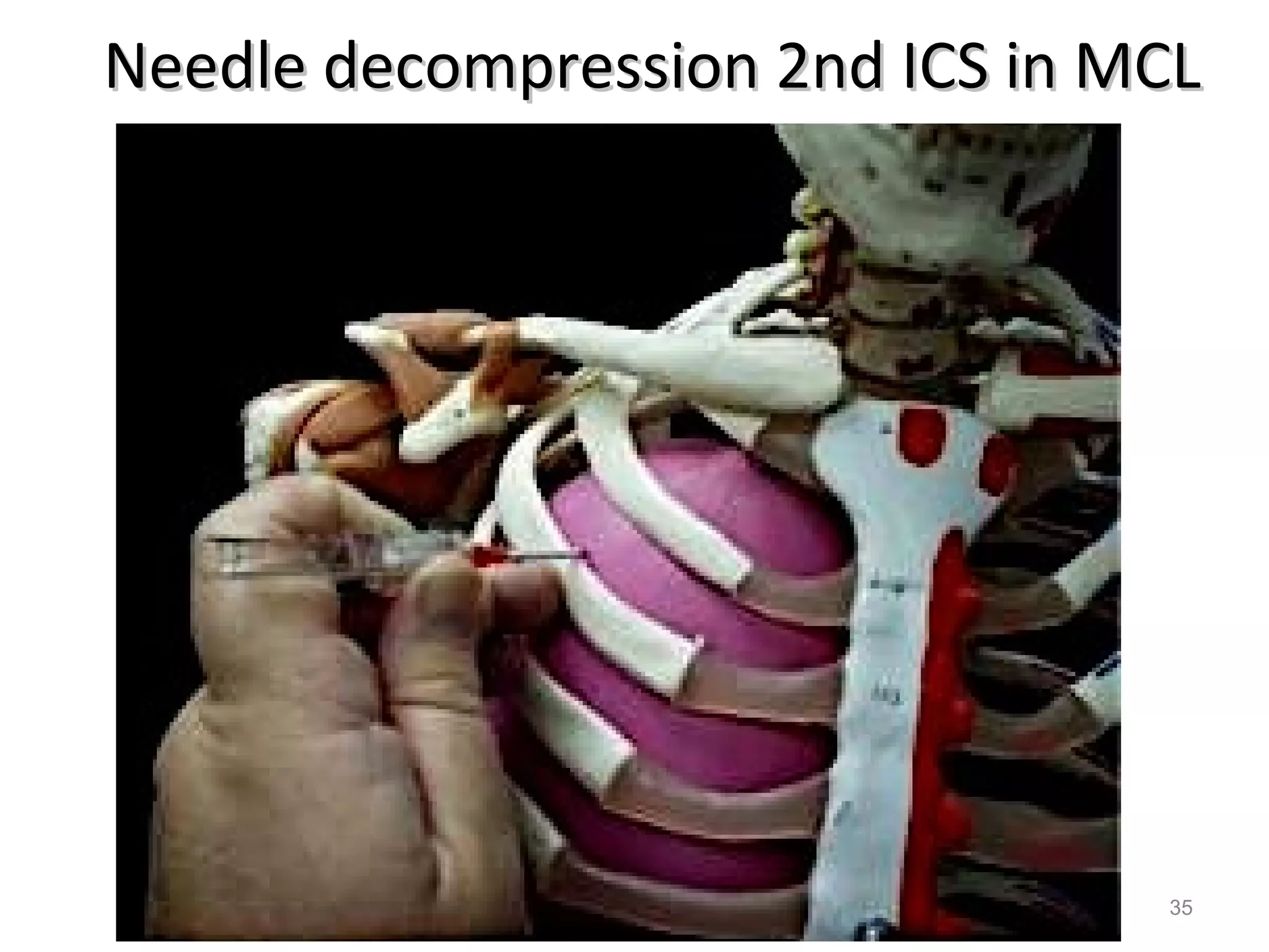Thoracic cavity & mediastinum | PPT