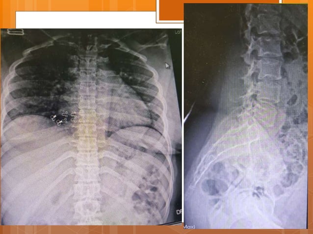 Thoracic disc disease | PPT