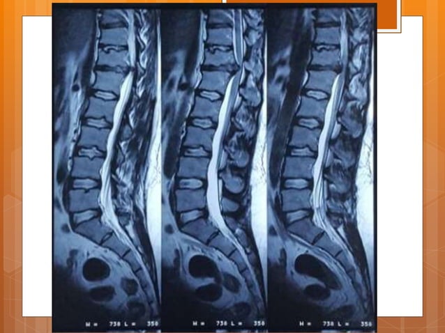 Thoracic disc disease | PPT
