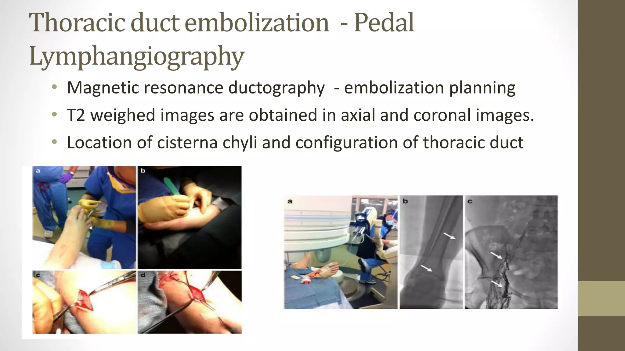 Thoracic duct injury in neck dissection | PPTX