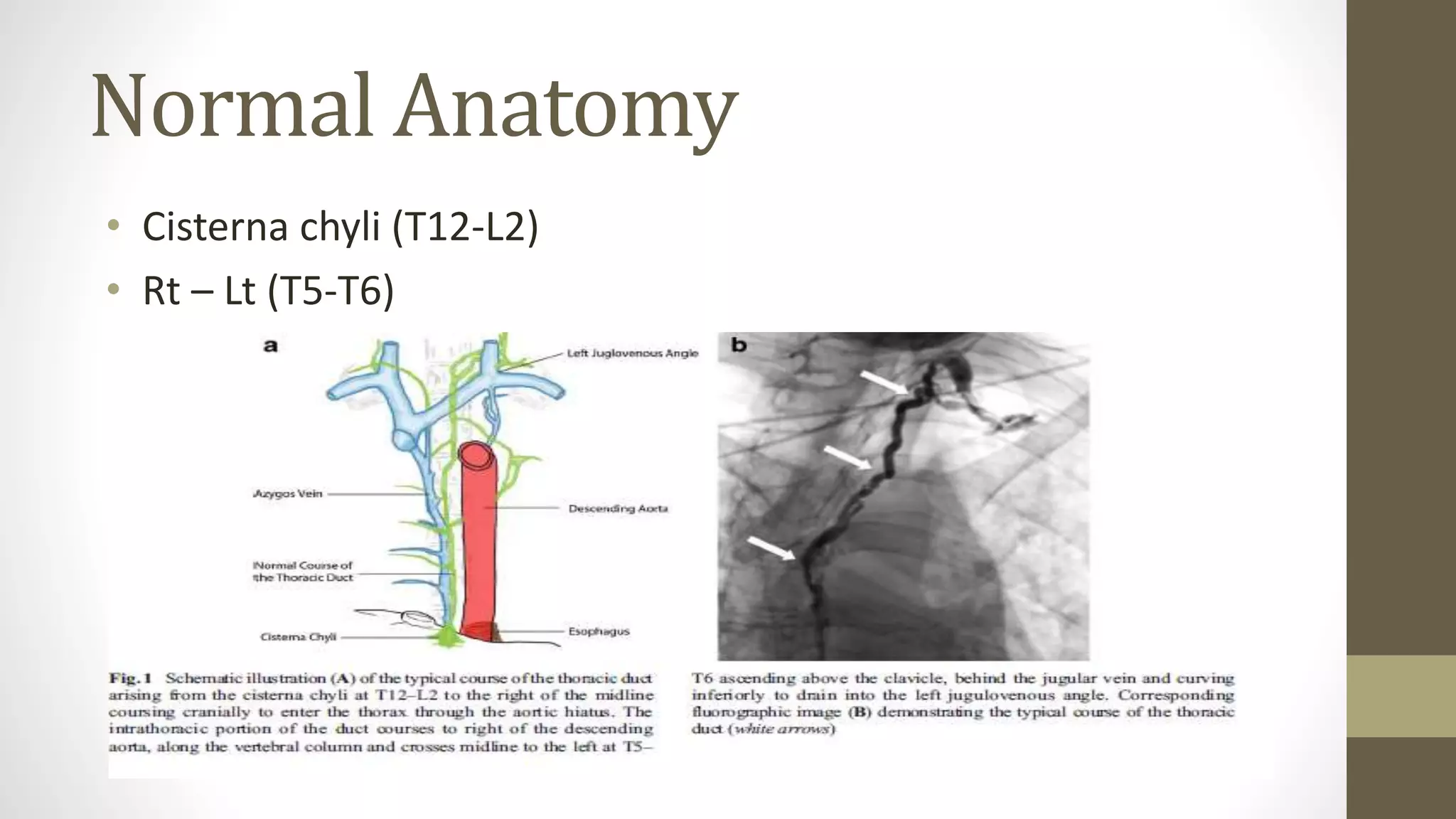 Thoracic duct injury in neck dissection | PPTX