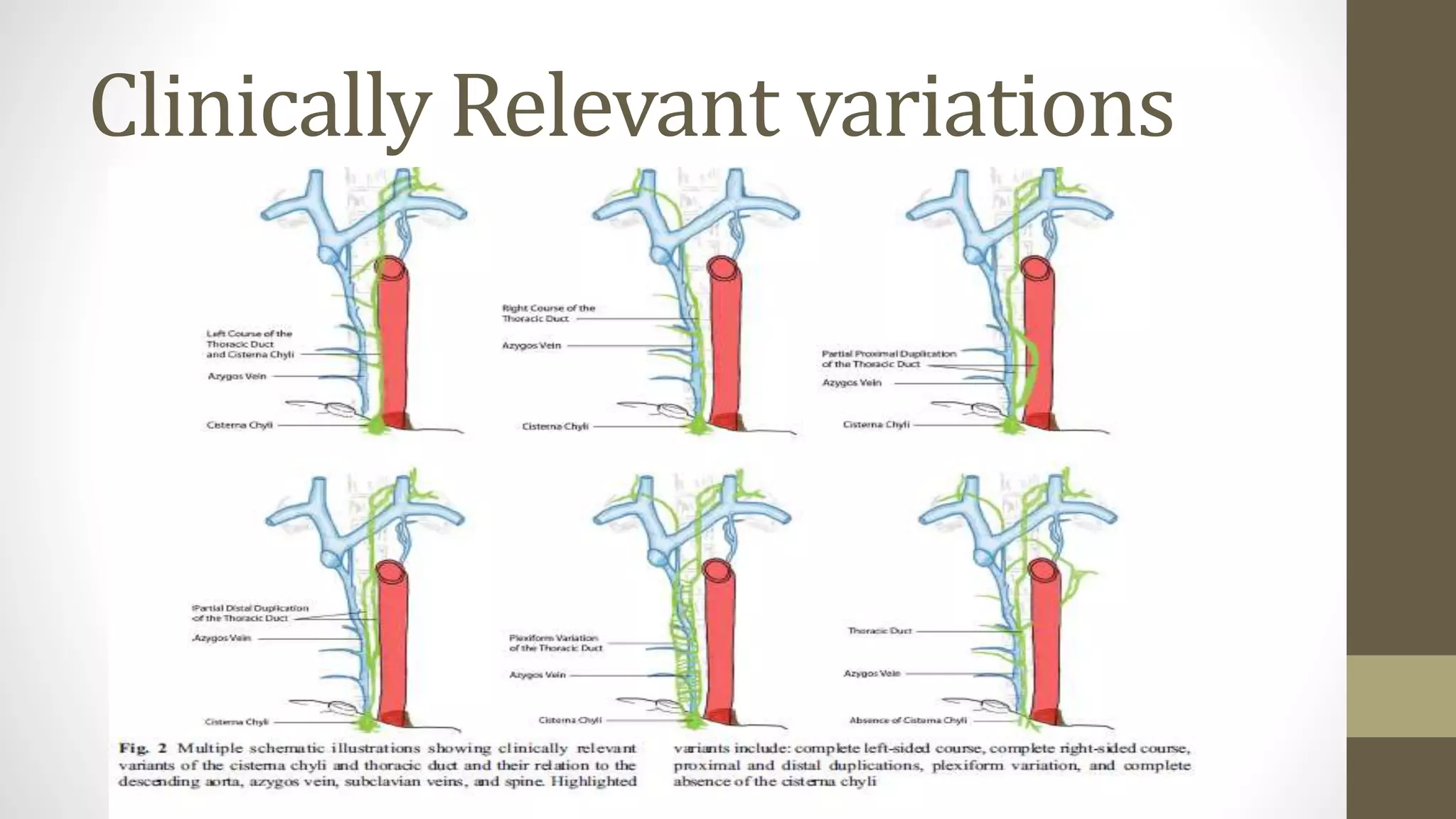 Thoracic duct injury in neck dissection | PPTX