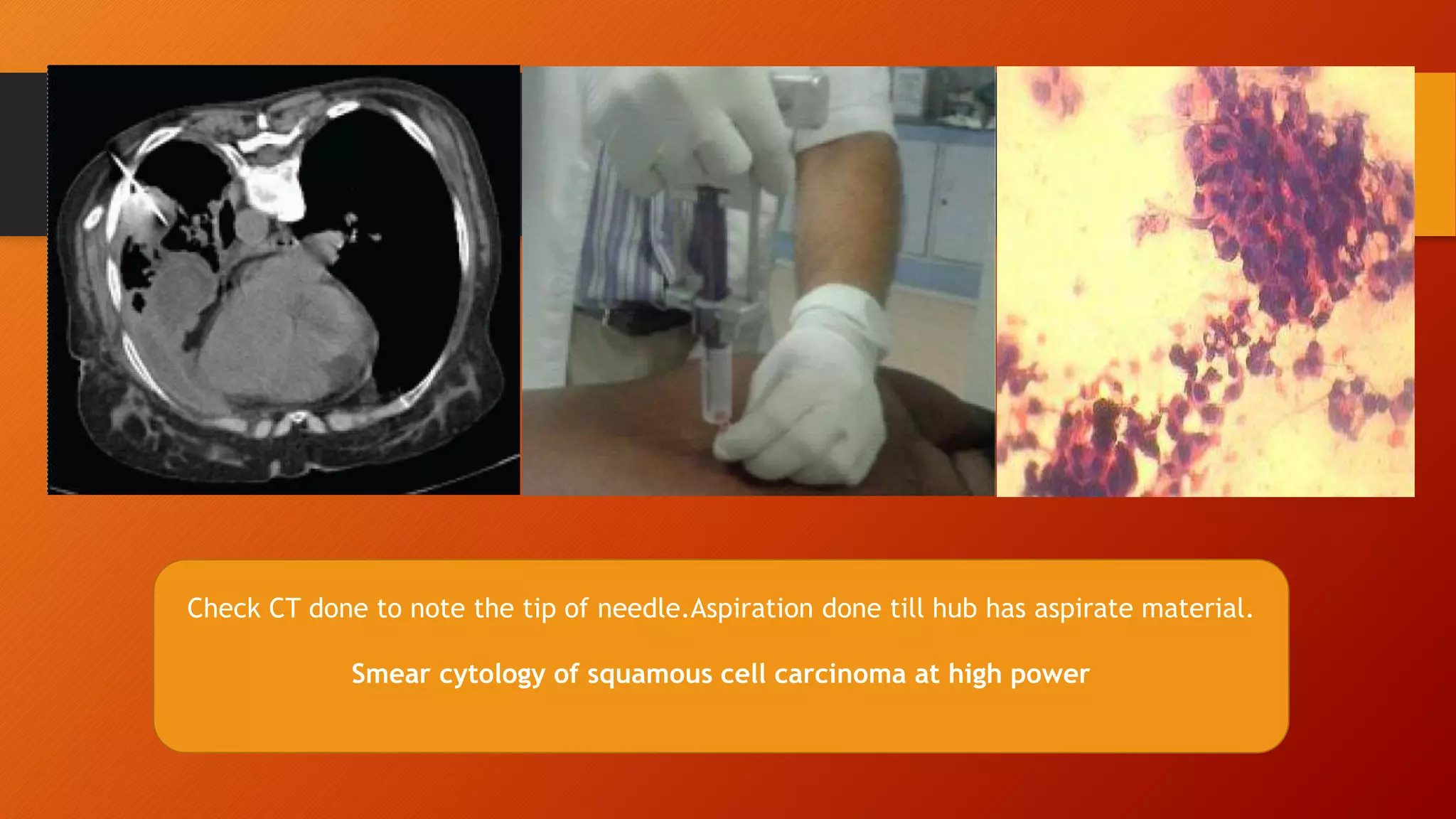 Thoracic fnac ct guided | PPTX