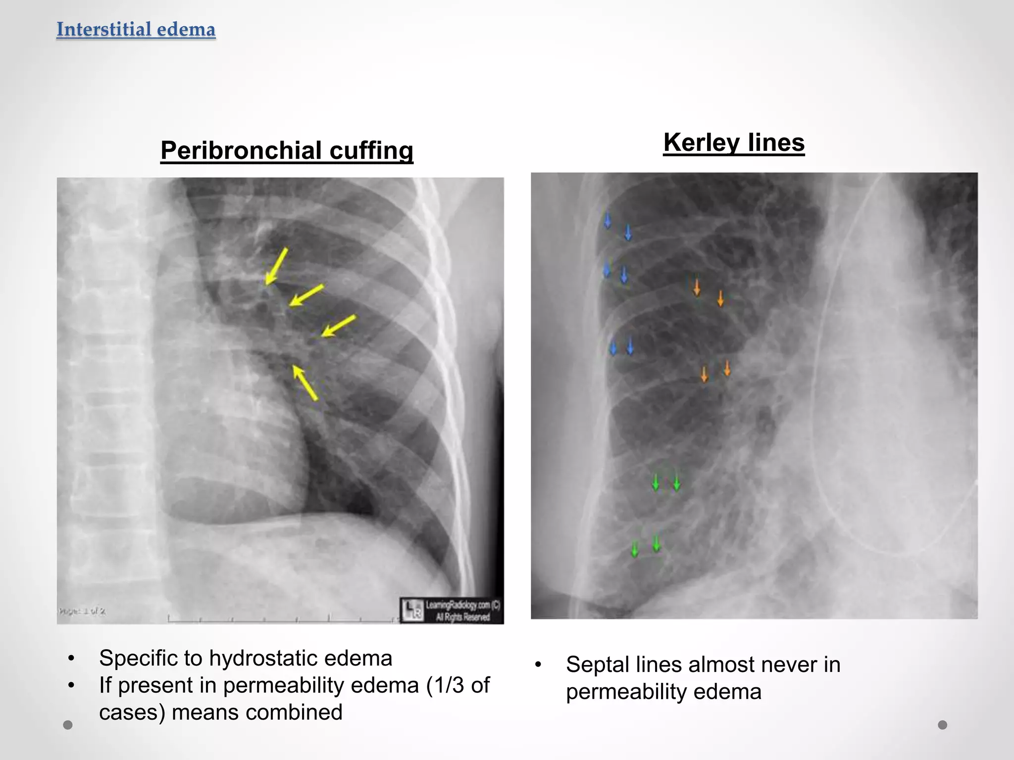 Thoracic imaging in icu | PPTX