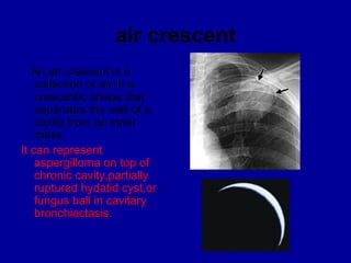 Thoracic imaging terms 2 | PPT | Lung and Respiratory Health | Diseases ...