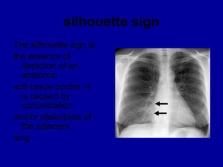 Thoracic imaging terms 2 | PPT | Lung and Respiratory Health | Diseases ...