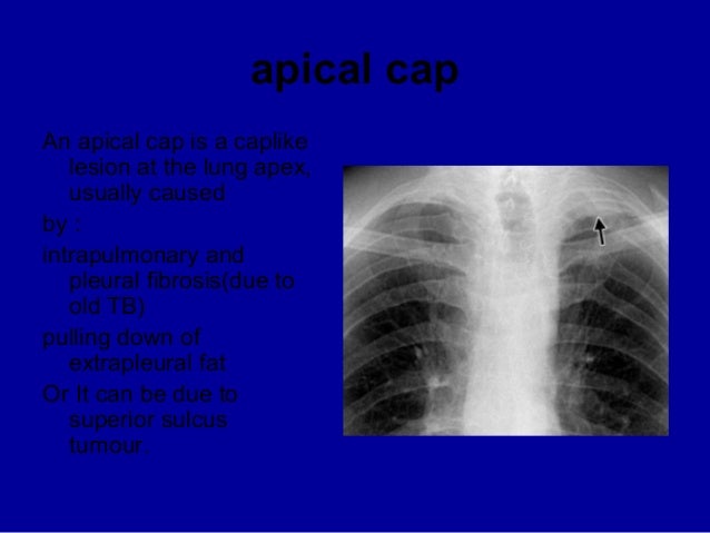 Thoracic imaging terms 2