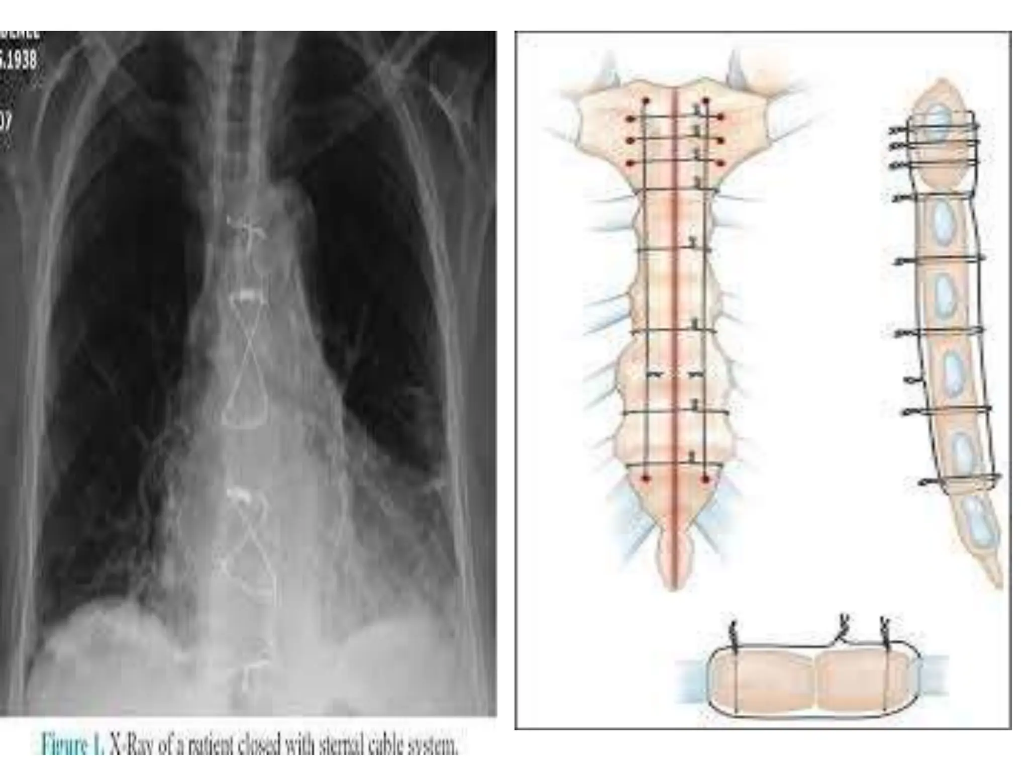 THORACIC INCISIONS a powerpoint for general surgeons | PPTX
