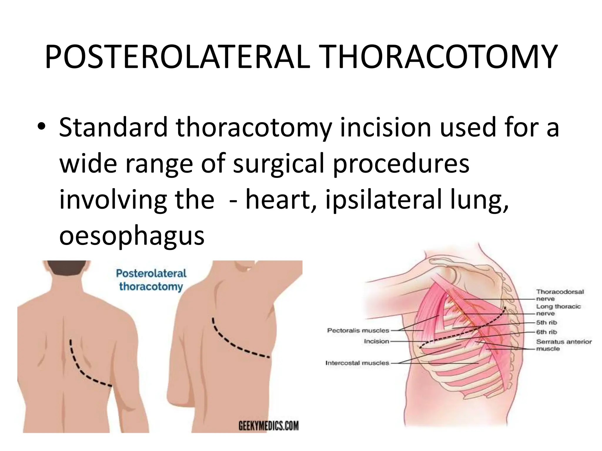 THORACIC INCISIONS a powerpoint for general surgeons | PPTX