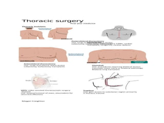 THORACIC INCISIONS a powerpoint for general surgeons | PPTX