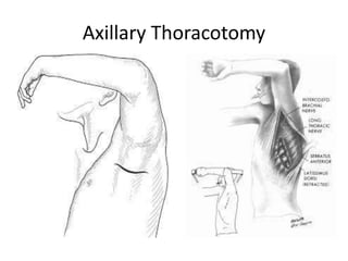 THORACIC INCISIONS a powerpoint for general surgeons | PPTX