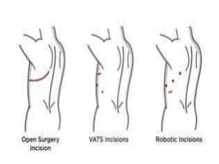 THORACIC INCISIONS a powerpoint for general surgeons | PPTX