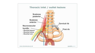 Thoracic inlet AND CERVICAL RIB SYNDROME. | PPTX
