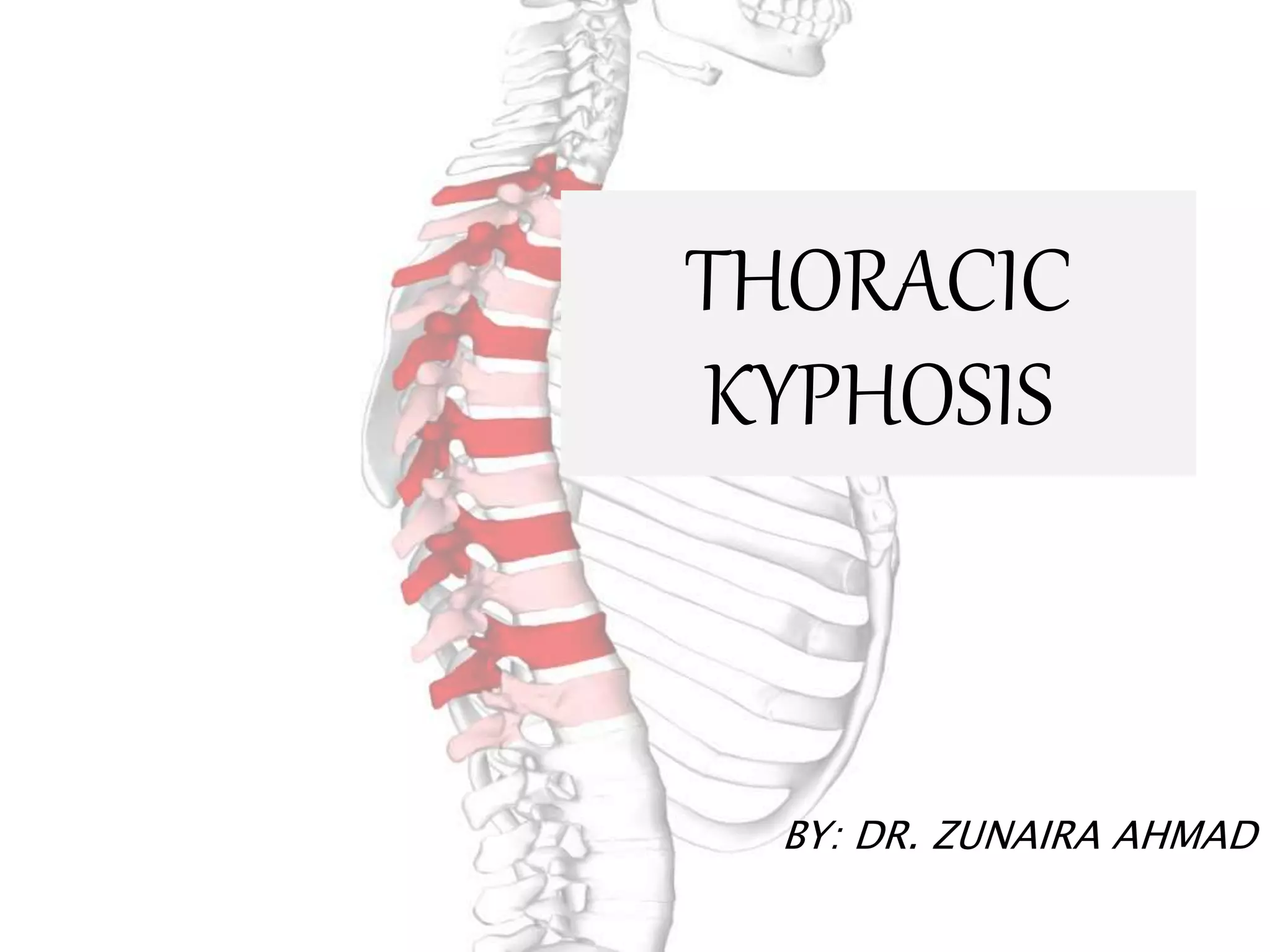 Thoracic kyphosis/ Thoracic hyperkyphosis | PPTX | Death, Injury, or ...