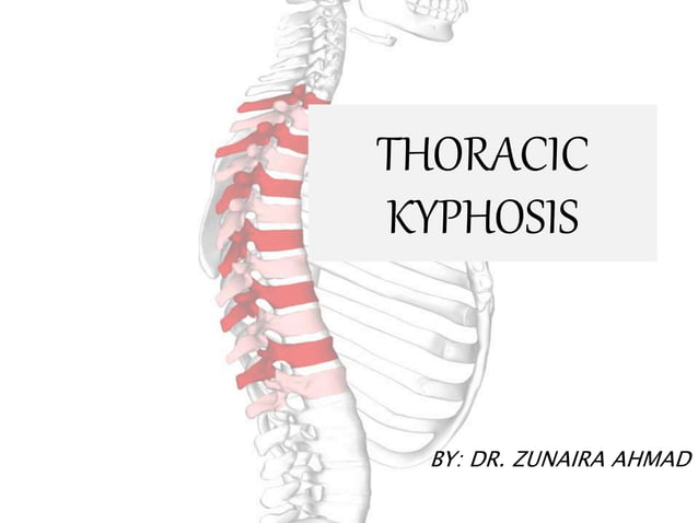 Thoracic kyphosis/ Thoracic hyperkyphosis | PPTX | Death, Injury, or ...