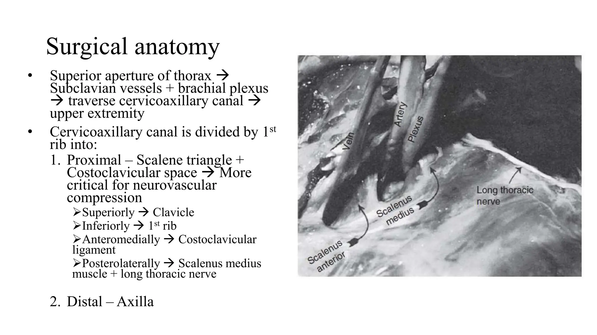Thoracic outlet syndrome-1.pptx