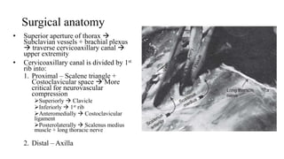 Thoracic outlet syndrome-1.pptx