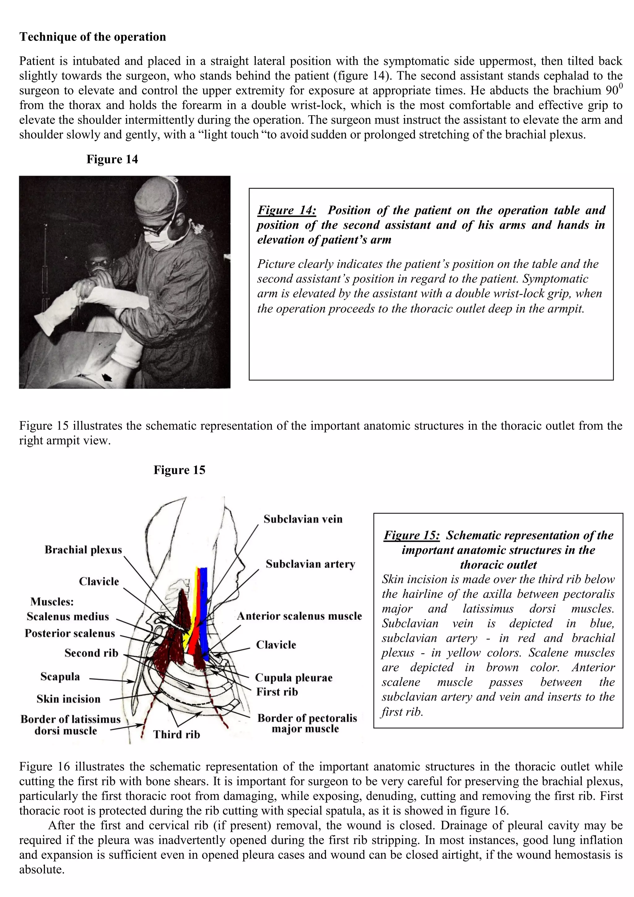 Thoracic Outlet Syndrome: Anatomy, Symptoms, Diagnostic Evaluation and ...