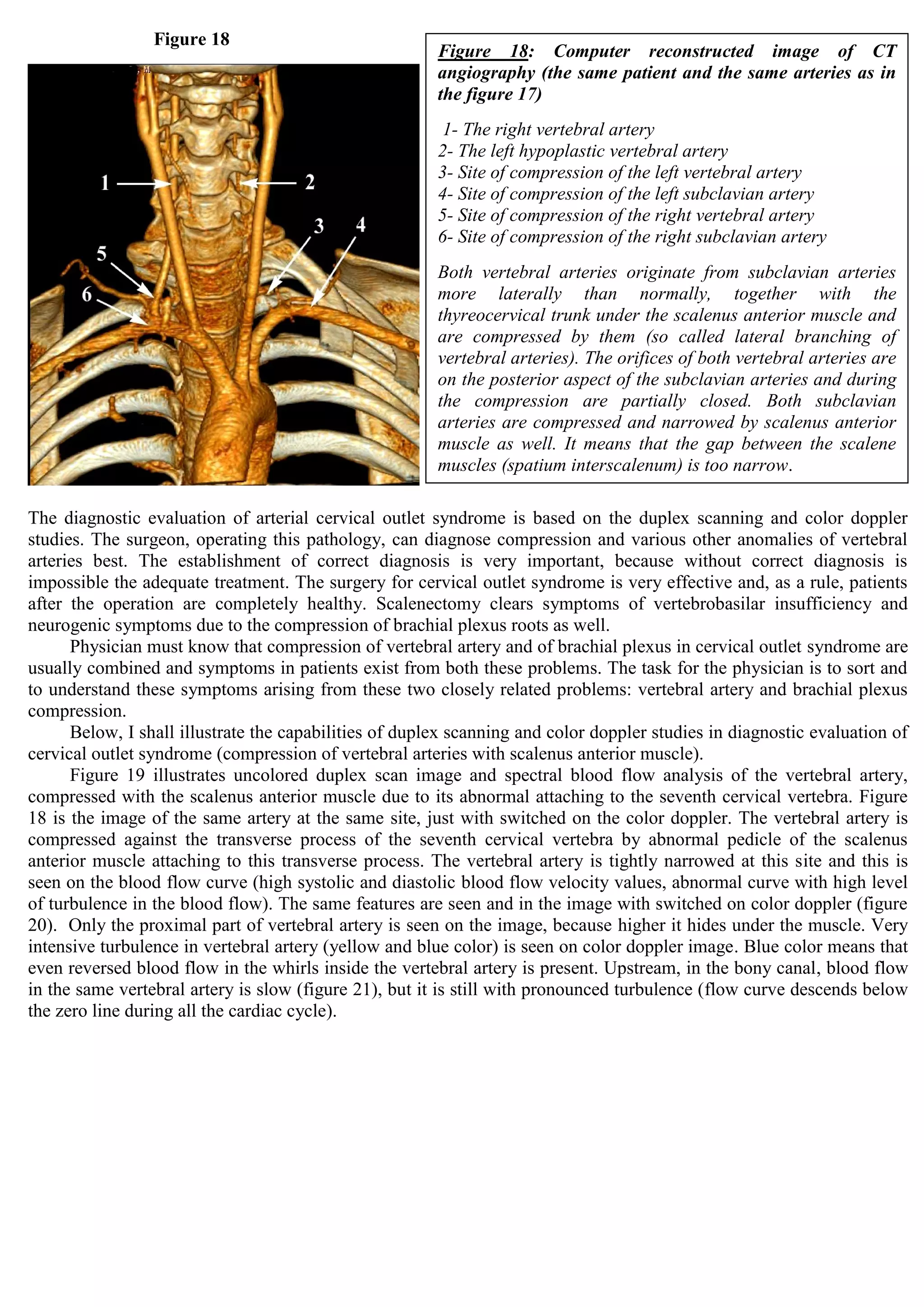 Thoracic Outlet Syndrome: Anatomy, Symptoms, Diagnostic Evaluation and ...