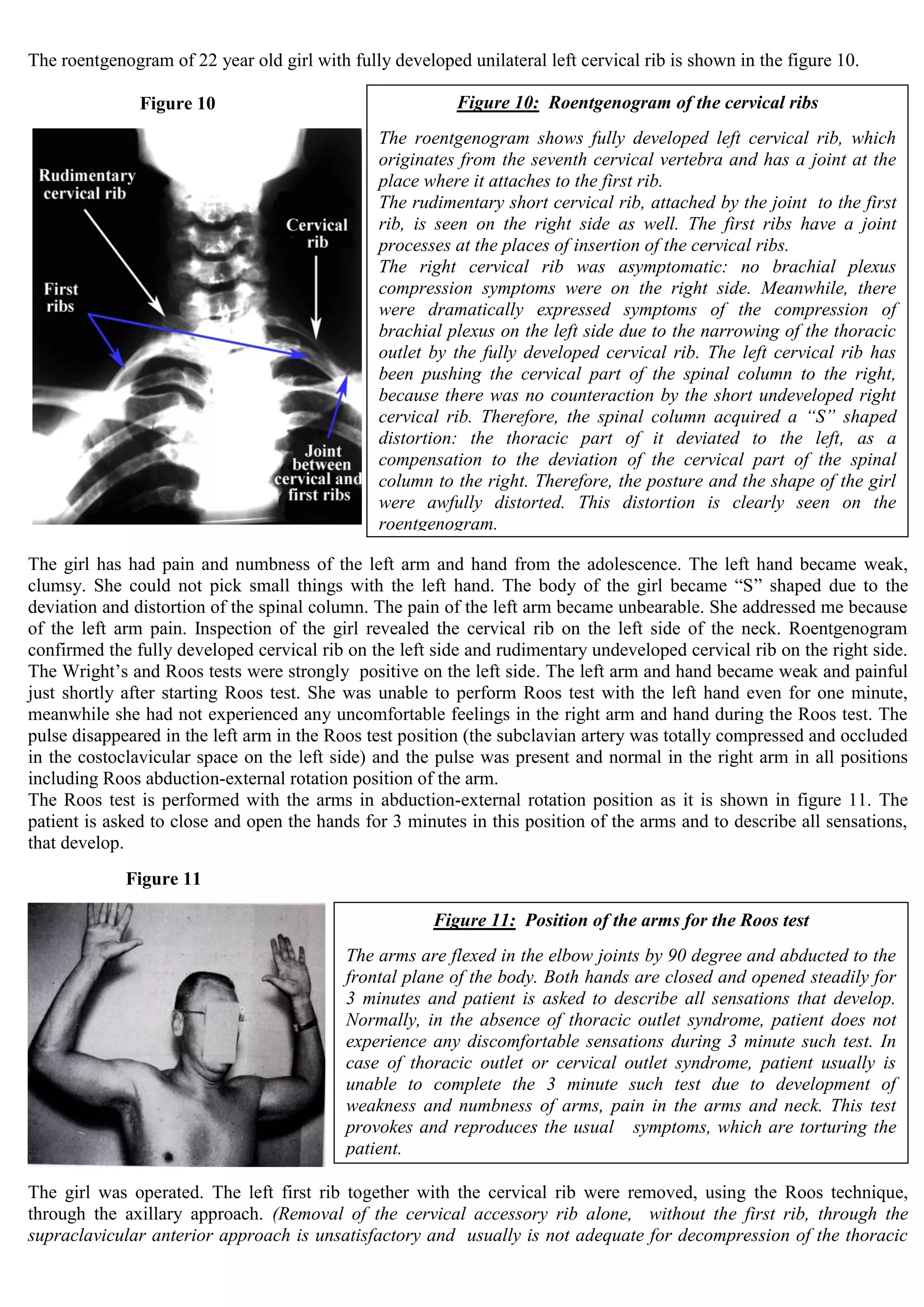 Thoracic Outlet Syndrome: Anatomy, Symptoms, Diagnostic Evaluation and ...