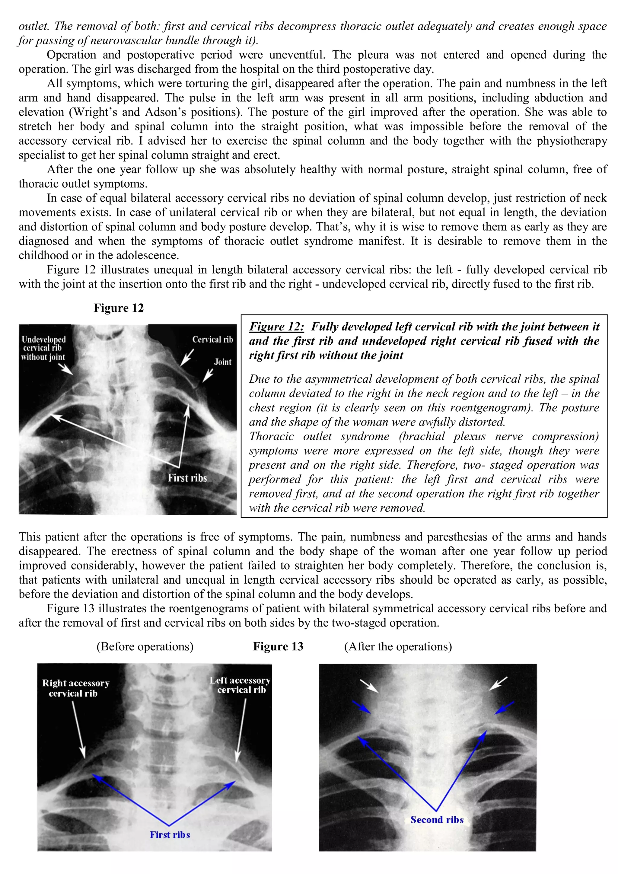 Thoracic Outlet Syndrome: Anatomy, Symptoms, Diagnostic Evaluation and ...